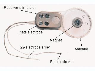 How does a cochlear implant work. — kidcyber