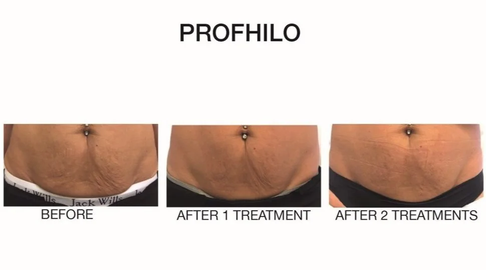 PROFHILO Body — Pelle Aesthetics