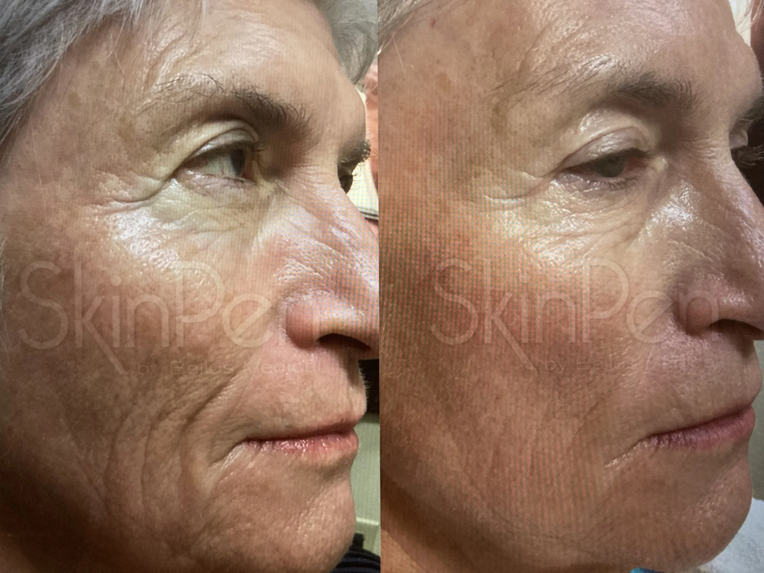 Skinpen Precision — Pelle Aesthetics