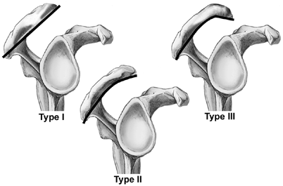 The number One Reason for Shoulder Impingement in CrossFit — Arrow ...