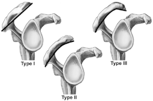 The number One Reason for Shoulder Impingement in CrossFit — Arrow ...