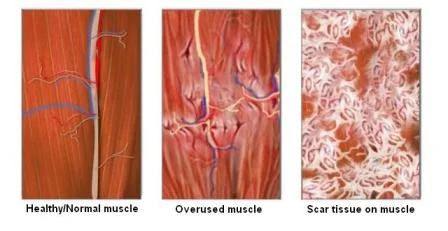 Overuse Injuries in CrossFit — Arrow Physical Therapy Seattle