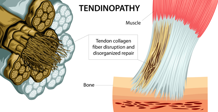 Tendon Injury in Athletes — Arrow Physical Therapy Seattle