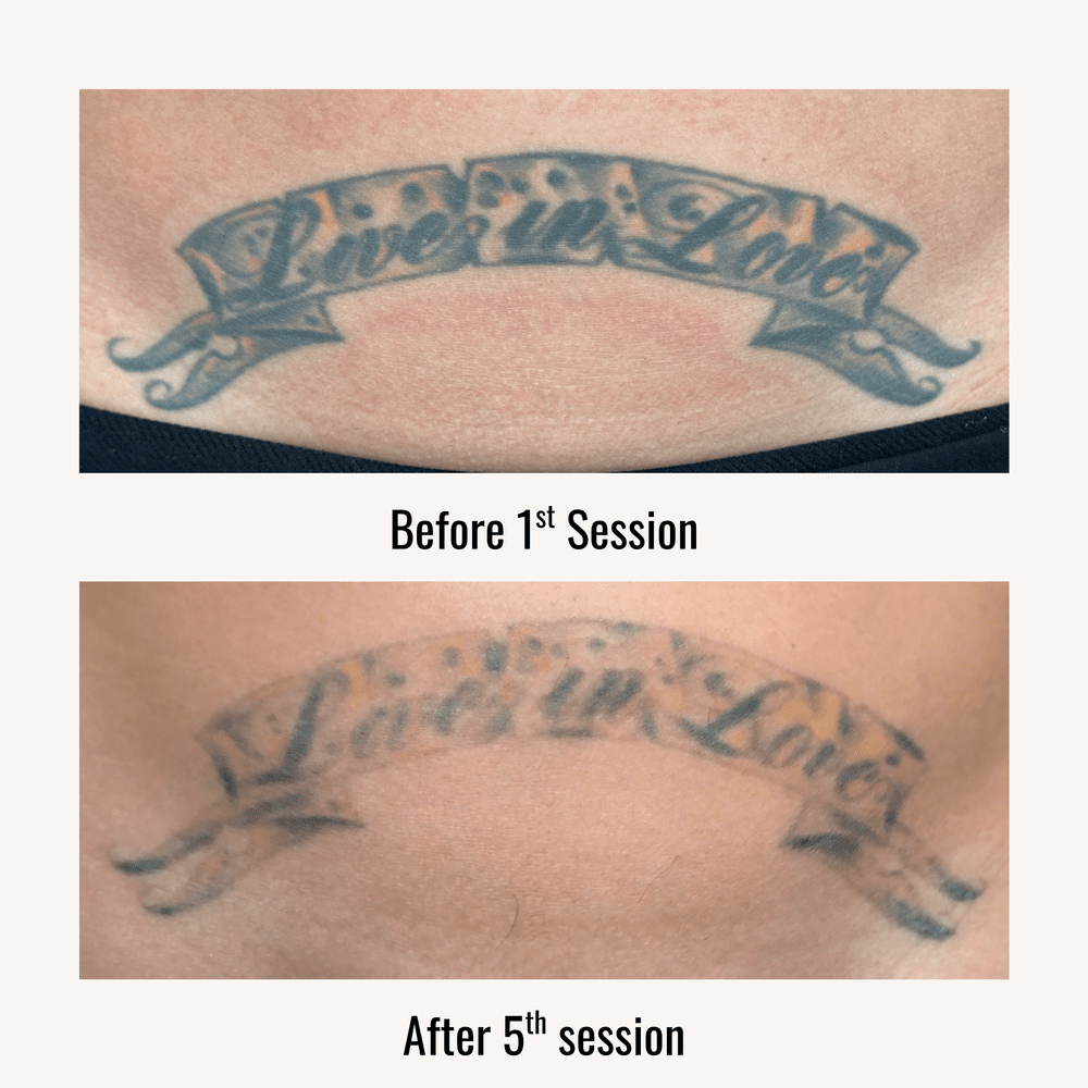 Lightening a Tattoo for a Cover-Up: What to Expect (and Why It’s Easier ...