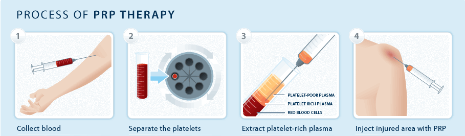 Plasma Rich Protein (PRP) Injection — ESSMC