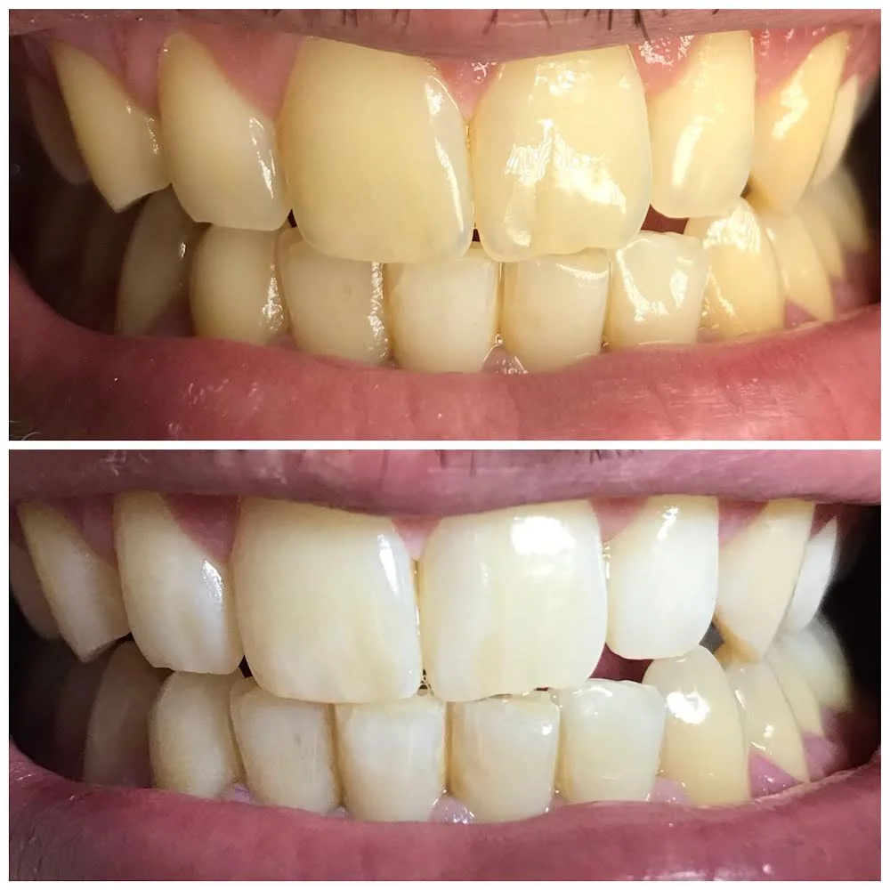 Zahnbleaching — Just Beautiful