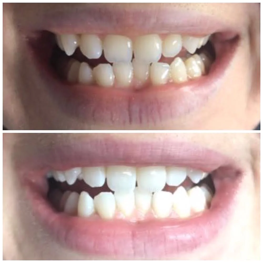 Zahnbleaching — Just Beautiful