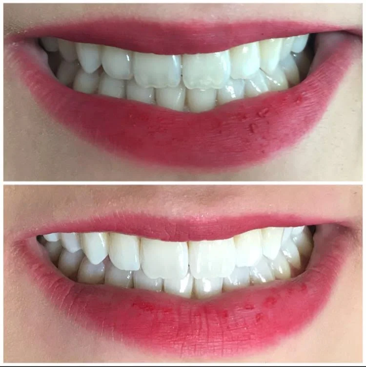 Zahnbleaching — Just Beautiful