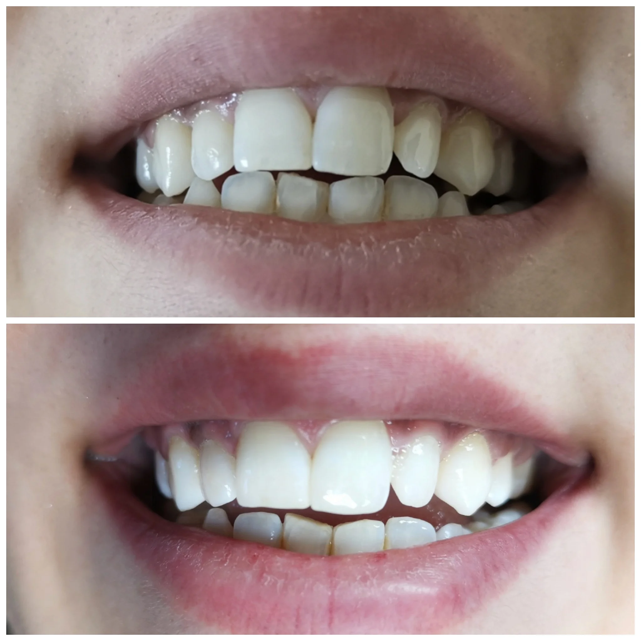 Zahnbleaching — Just Beautiful