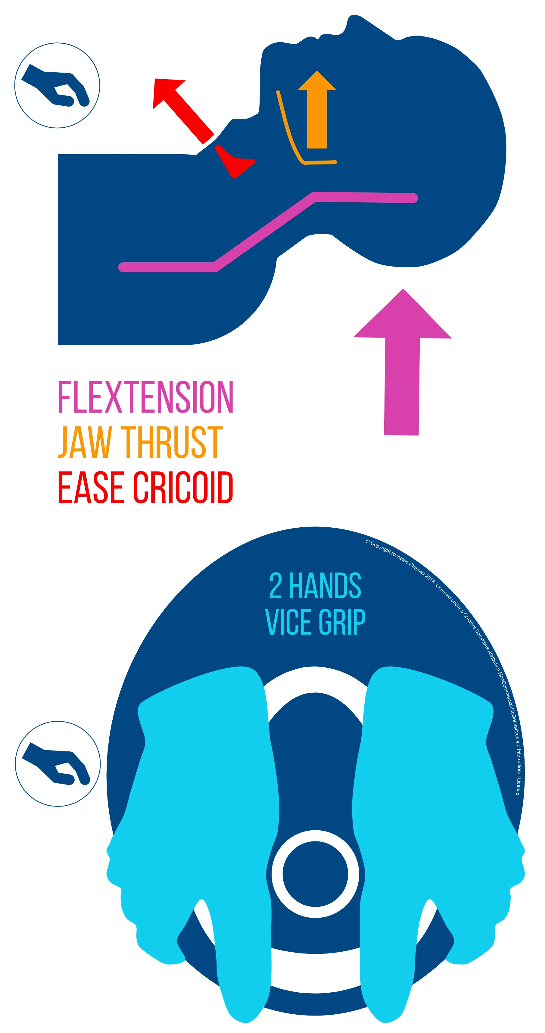 Vortex Airway RESCUE Cart — The Vortex Approach