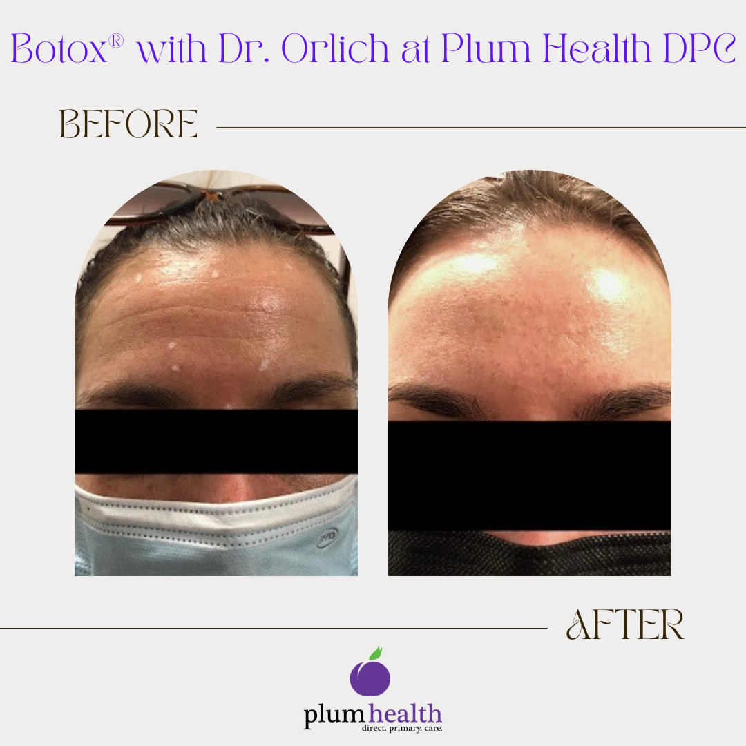 Botox — Plum Health - Direct Primary Care in Detroit, Michigan