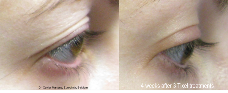 TIXEL® Non Invasive Skin Resurfacing — IDEAL SKIN MEDSPA