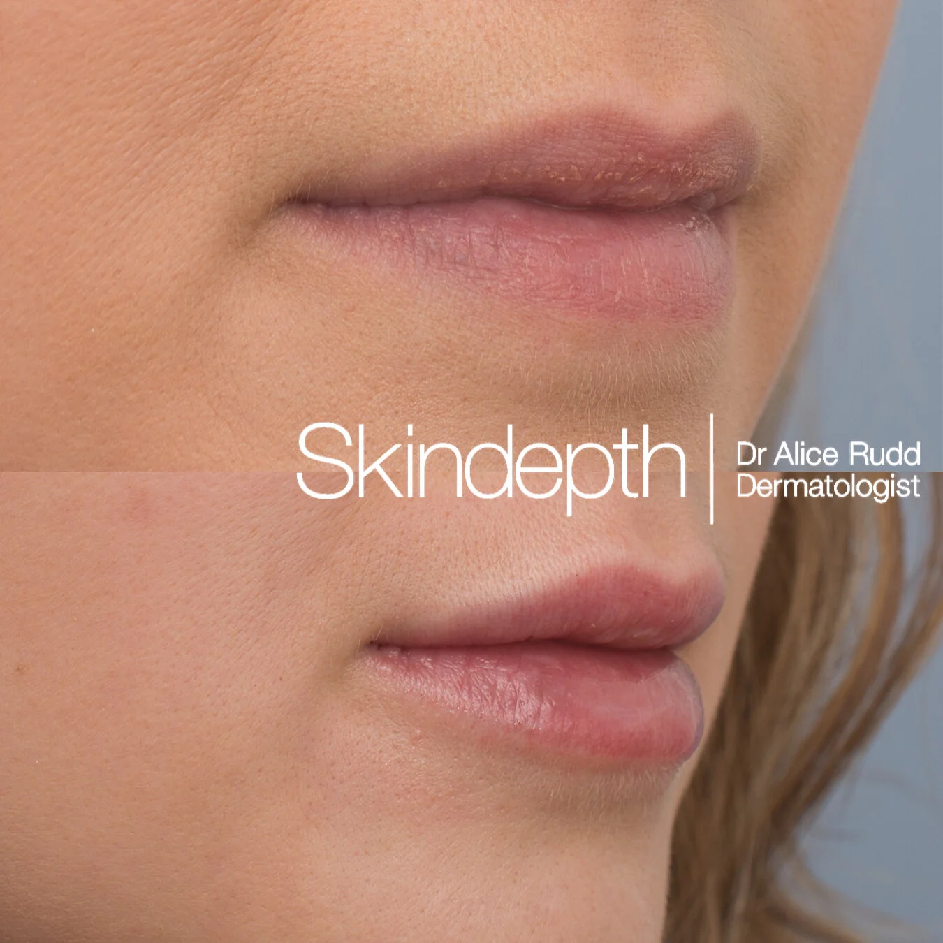 Dermal Fillers — Skin Depth Dermatology