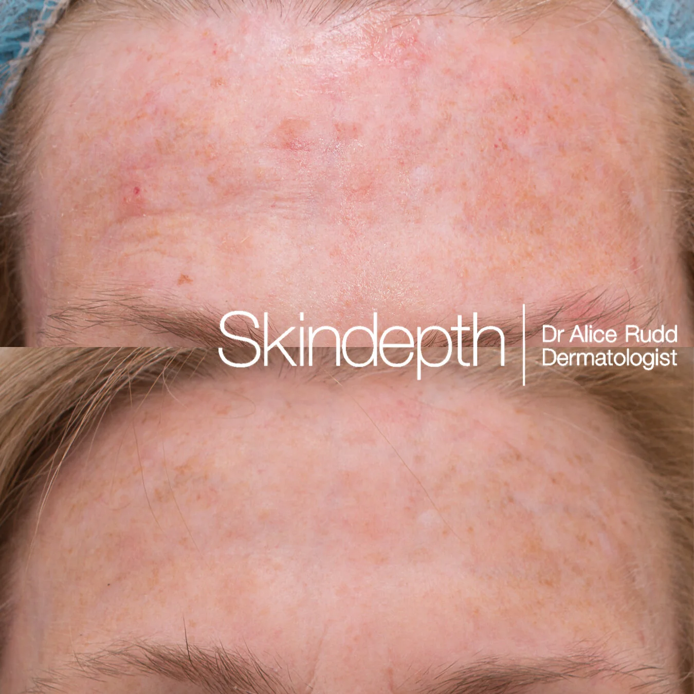 V Beam Laser Melbourne - The Best Picture Of Beam