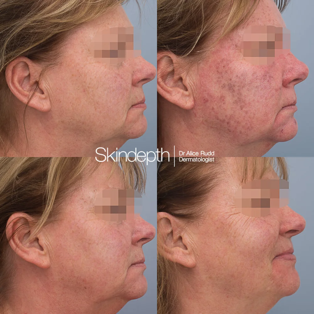 V Beam Laser Melbourne - The Best Picture Of Beam