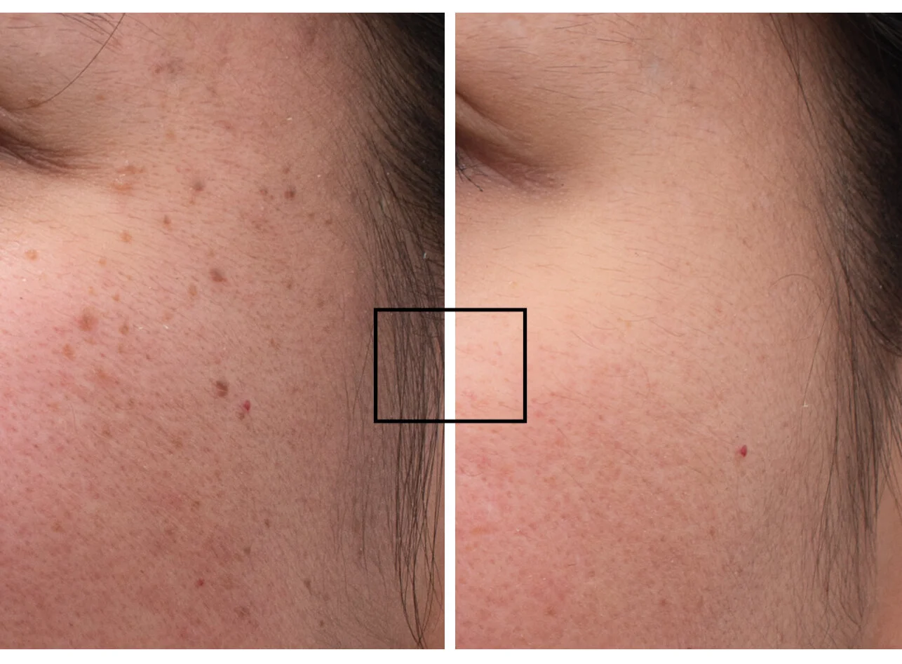 Medical Grade Laser — Skin Depth Dermatology