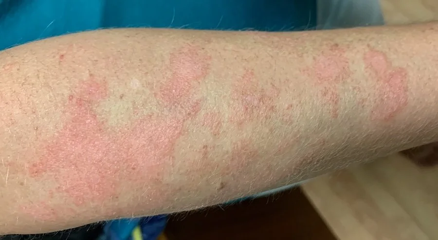 Inflammation and the skin — Skin Depth Dermatology