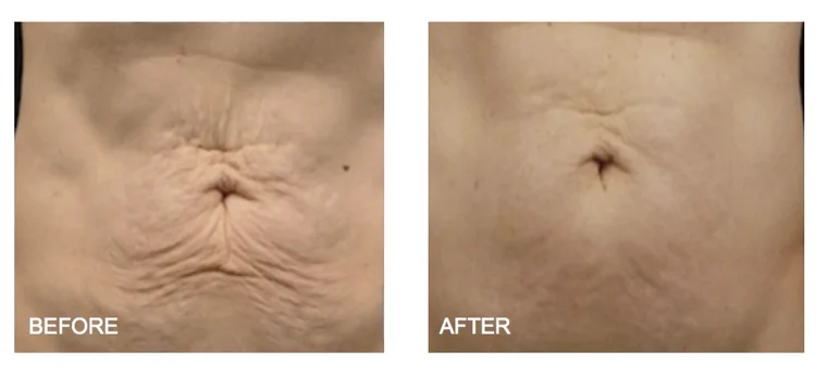 HIFU Skin Tightening Treatment Sydney | Non Surgical Face Lift | Skin ...