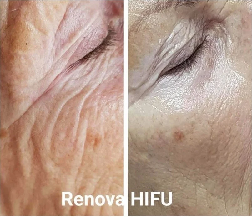 HIFU Skin Tightening Treatment Sydney | Non Surgical Face Lift | Skin ...