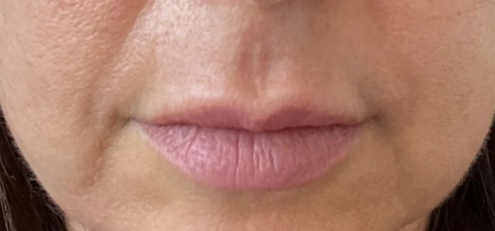 Plasma Pen Fibroblasting Eyelid Treatment | Skin Body Health