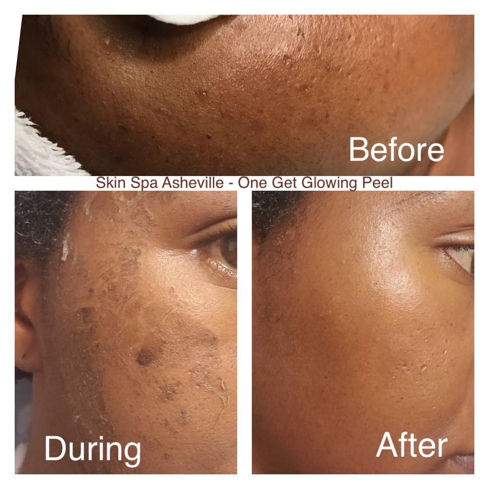 Elaine Brennan Peel, Micro Peel & Chemical Peels | Skin Spa Asheville