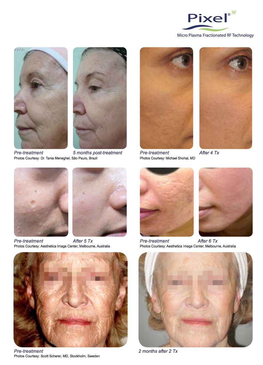 Pixel Laser Recovery