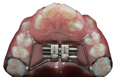 Expansion — North Shore Orthodontics