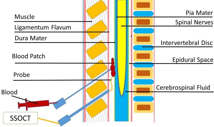 How To Increase Healing Of Dura Mater After Lumbar Puncture, Epidural ...