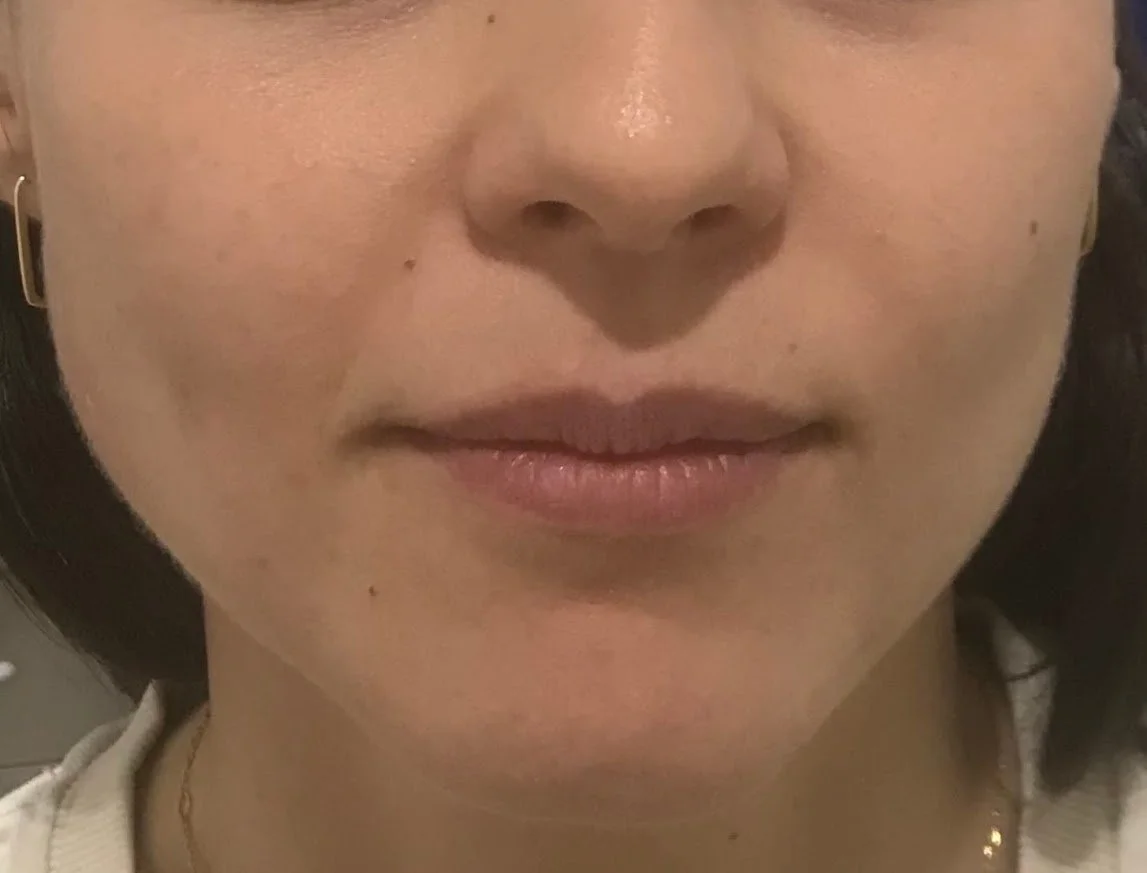 Jaw Muscle Relaxing Injections — YourSkin Clinic