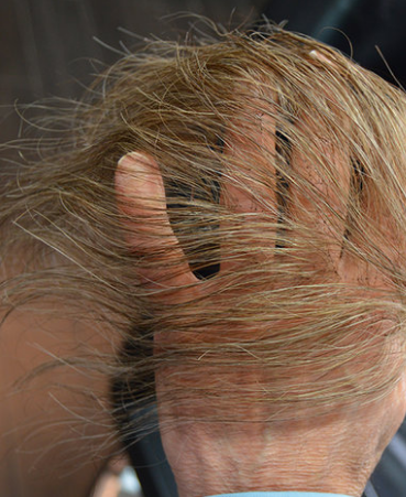 Best Hair Extensions NJ | Non Surgical Hair Replacement NJ ...