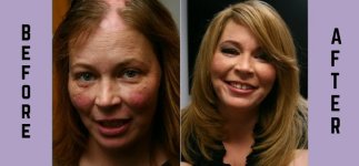 InvisaBlend® Hair Loss Solutions | The Healthy Approach to Fuller Hair
