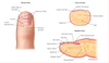 Approach to Evaluation and Management of Traumatic Finger Amputations — BROWN EMERGENCY MEDICINE ...