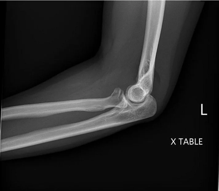 Doing More With Less: Management of Radial Head Fractures in the ED ...