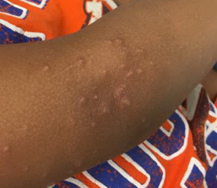 CITW 17: A Crusty Rash — BROWN EMERGENCY MEDICINE BLOG