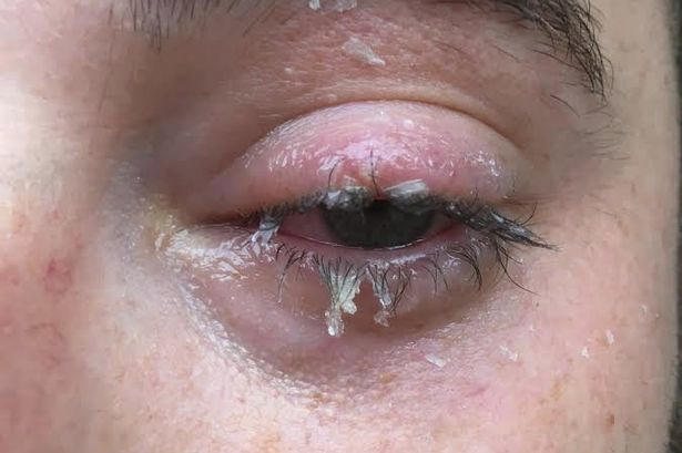 Super Glued Shut — BROWN EMERGENCY MEDICINE BLOG