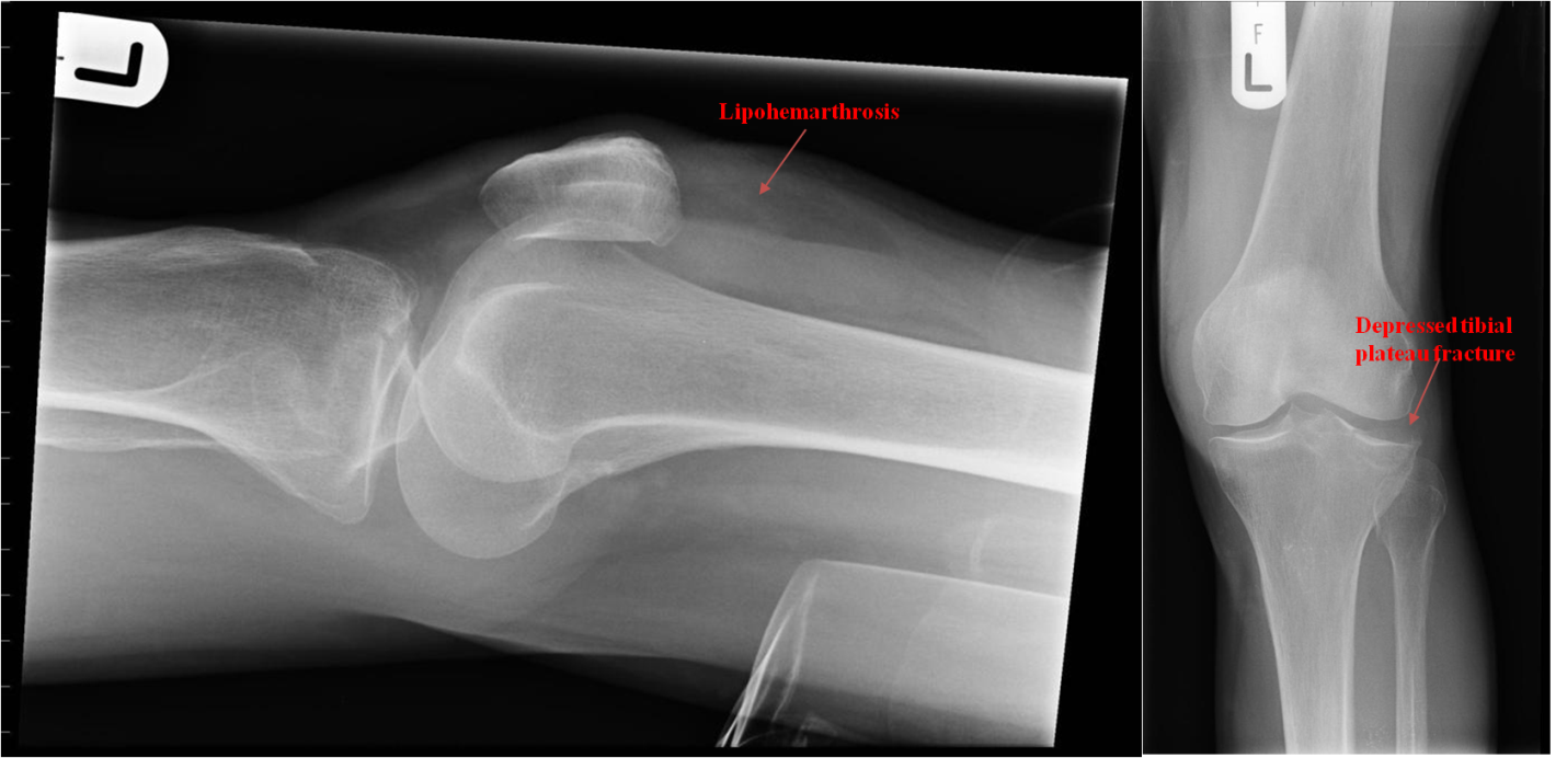 The Great Plateau — BROWN EMERGENCY MEDICINE BLOG