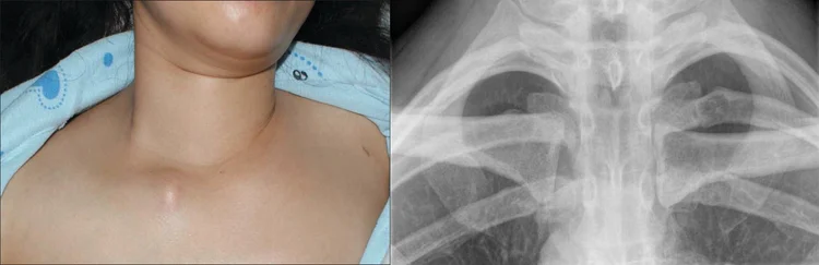 Sternoclavicular Joint Dislocation: Serious concern or not a big deal ...