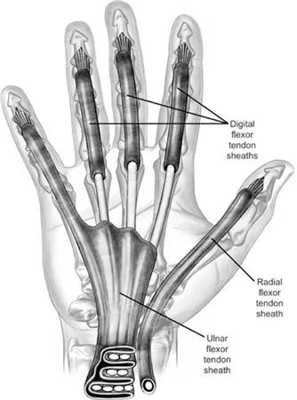 Getting a Hand-le on Pyogenic Flexor Tenosynovitis — BROWN EMERGENCY ...