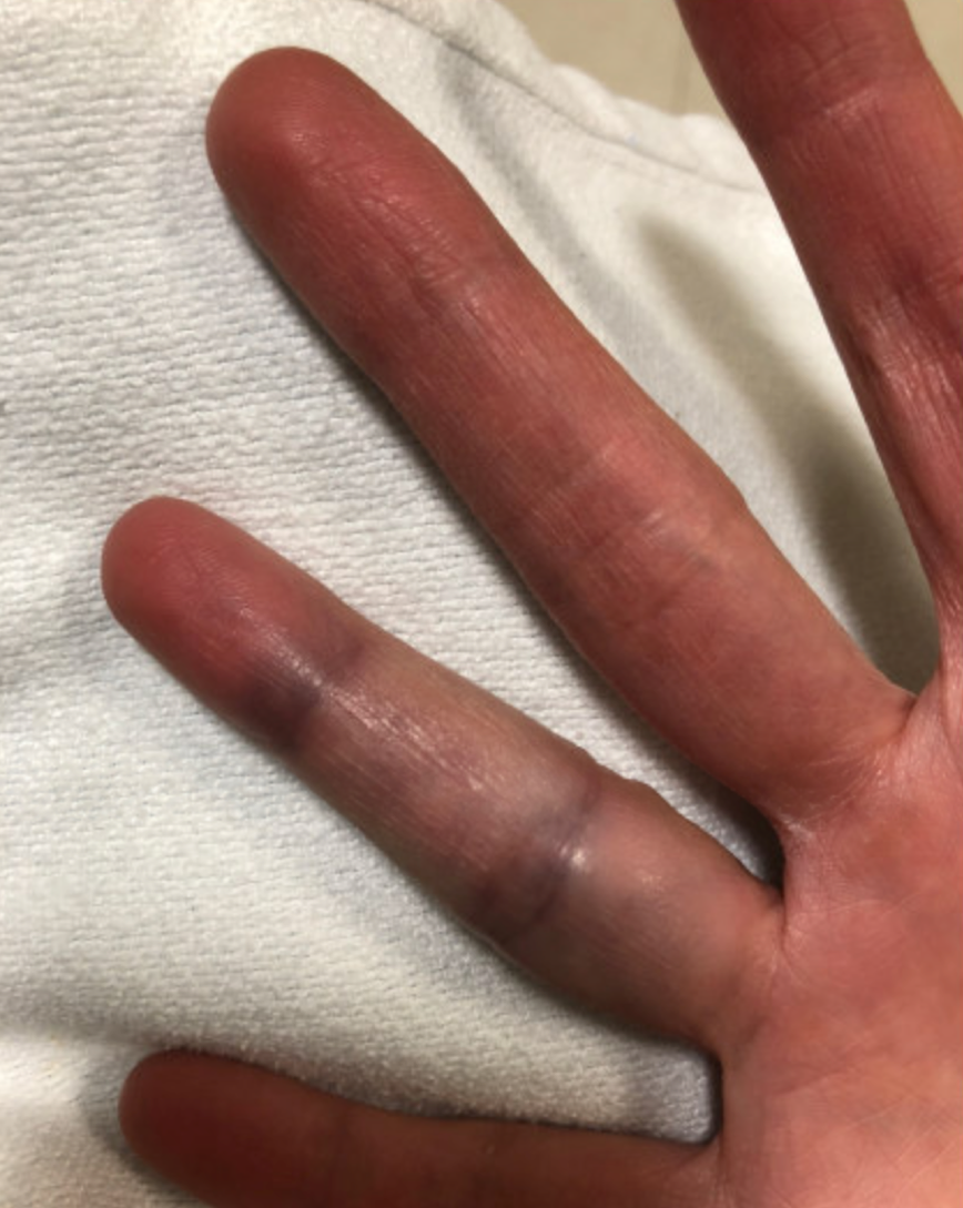 Clinical Image of the Month: Achenbach's Syndrome — BROWN EMERGENCY ...