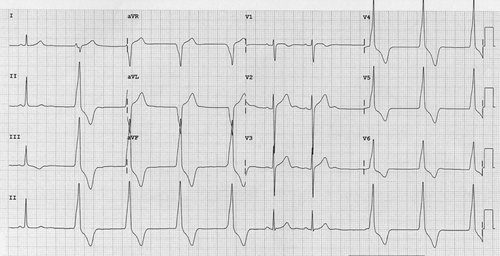 Fibrinolytic Therapy for STEMI — BROWN EMERGENCY MEDICINE BLOG