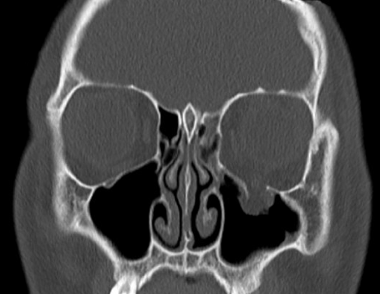 Trapdoor Fracture Orbital Floor Radiology | Viewfloor.co