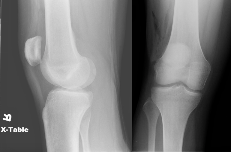 Take a Knee… — BROWN EMERGENCY MEDICINE