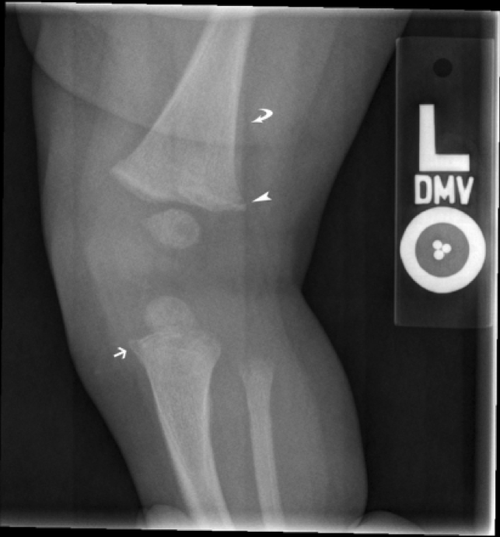 Bucket Handle Fracture