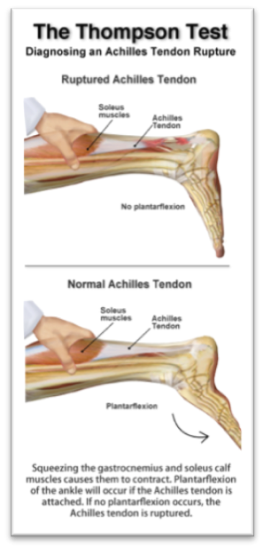 Achilles Tendon Rupture — BROWN EMERGENCY MEDICINE BLOG