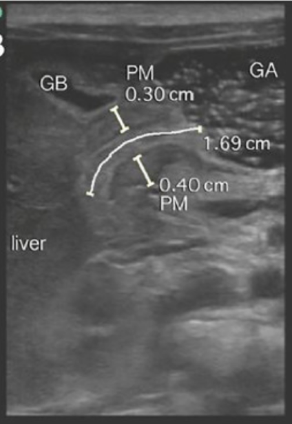 Brown Sound Point-Of-Care Ultrasound Diagnosis of Pyloric Stenosis ...