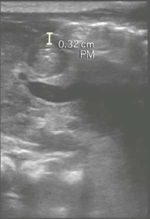 Brown Sound Point-Of-Care Ultrasound Diagnosis of Pyloric Stenosis ...