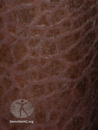 Tales From Honduras – Ichthyosis, An Unusual Skin Finding — BROWN ...