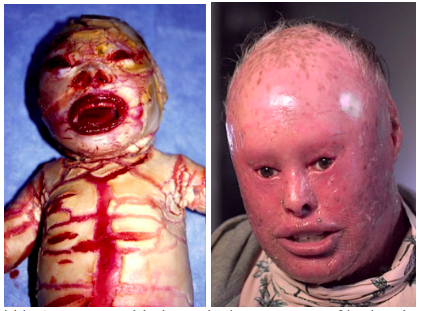 Tales From Honduras Ichthyosis An Unusual Skin Finding Brown