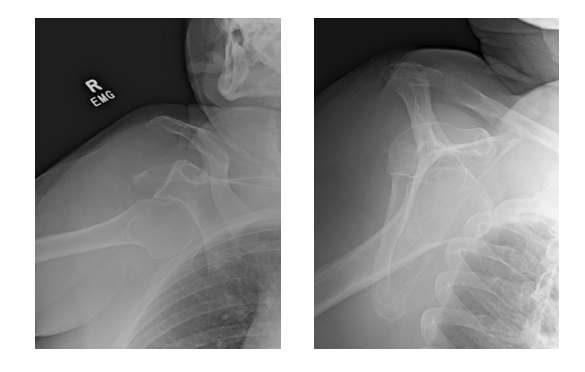 Nothing Humerus About It: An Approach to Shoulder Dislocations — BROWN ...