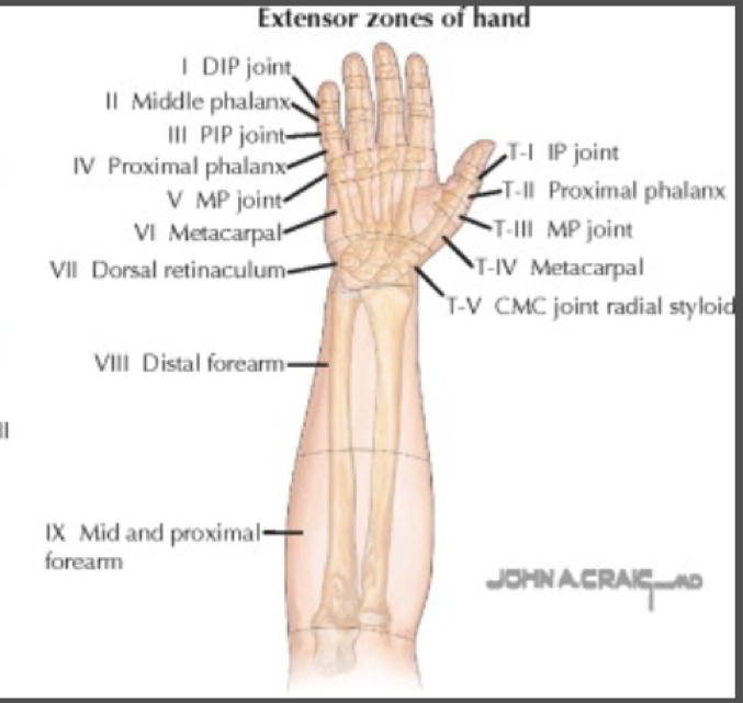 Open Extensor Tendon Repair in the ED — BROWN EMERGENCY MEDICINE BLOG